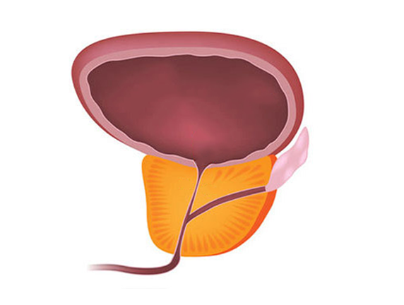 Learn How Early Diagnosis Can Help You Manage Causes For BPH - MASSH